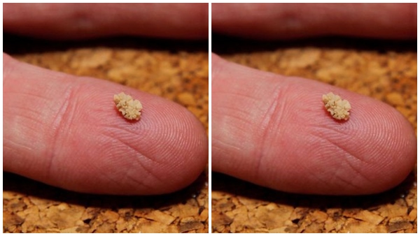 Sri Lankan Army Doctors Removed World's Largest Kidney Stone, Sets ...